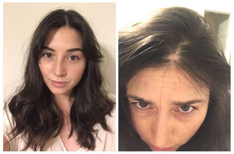 Here's What Finally Helped My Hair Loss From Stress | HUM Nutrition Blog Here's What Finally Helped My Hair Loss From Stress | HUM Nutrition Blog