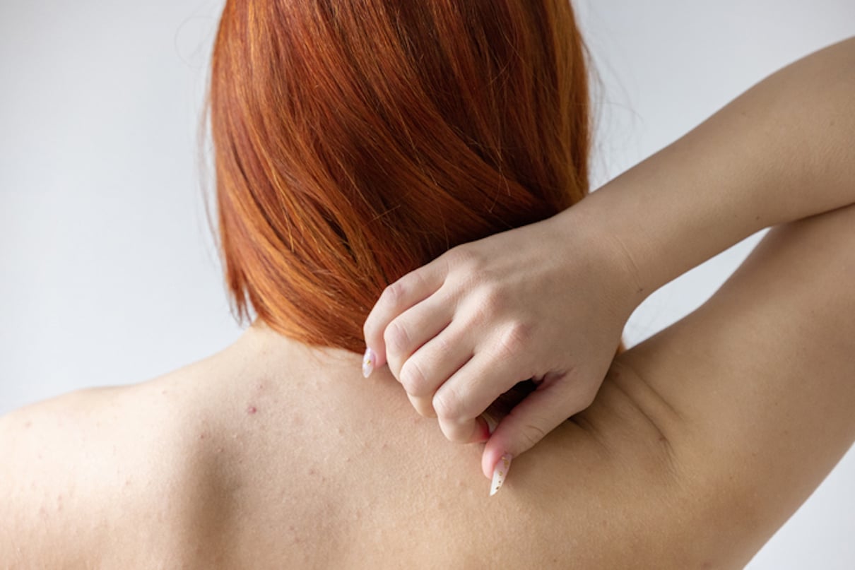 Body Acne by Area Explained | HUM Nutrition Blog